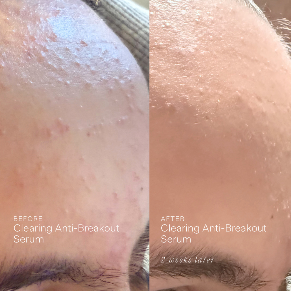 Anti-Breakout Starter Routine – Senne Skin