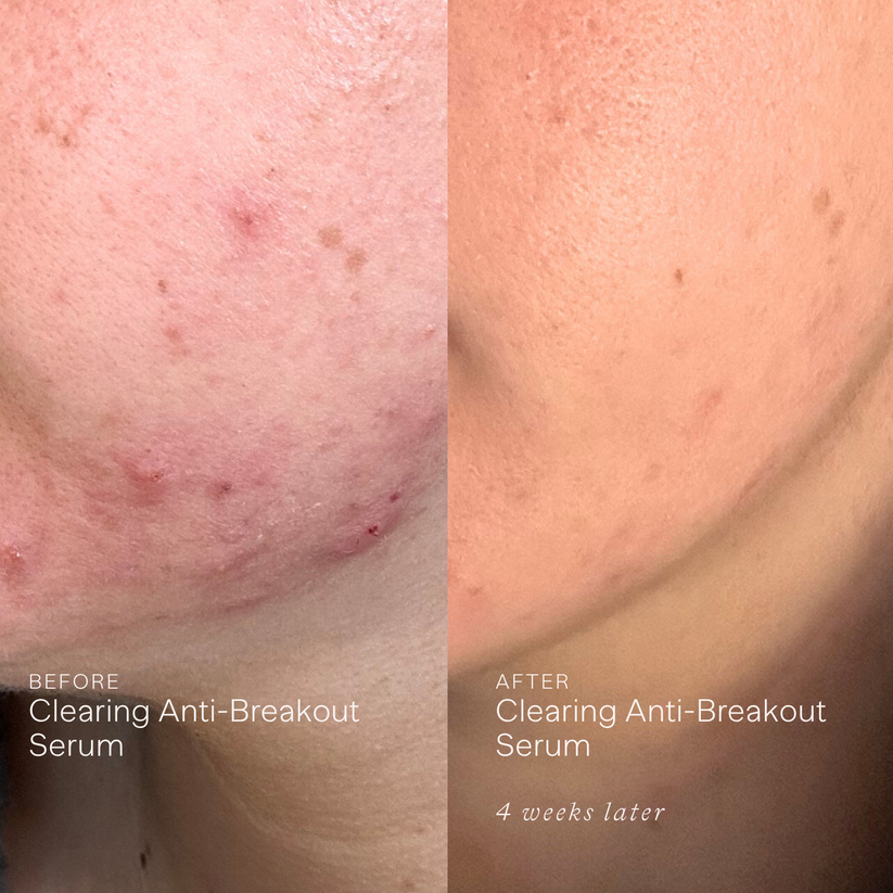 Anti-Breakout Starter Routine – Senne Skin